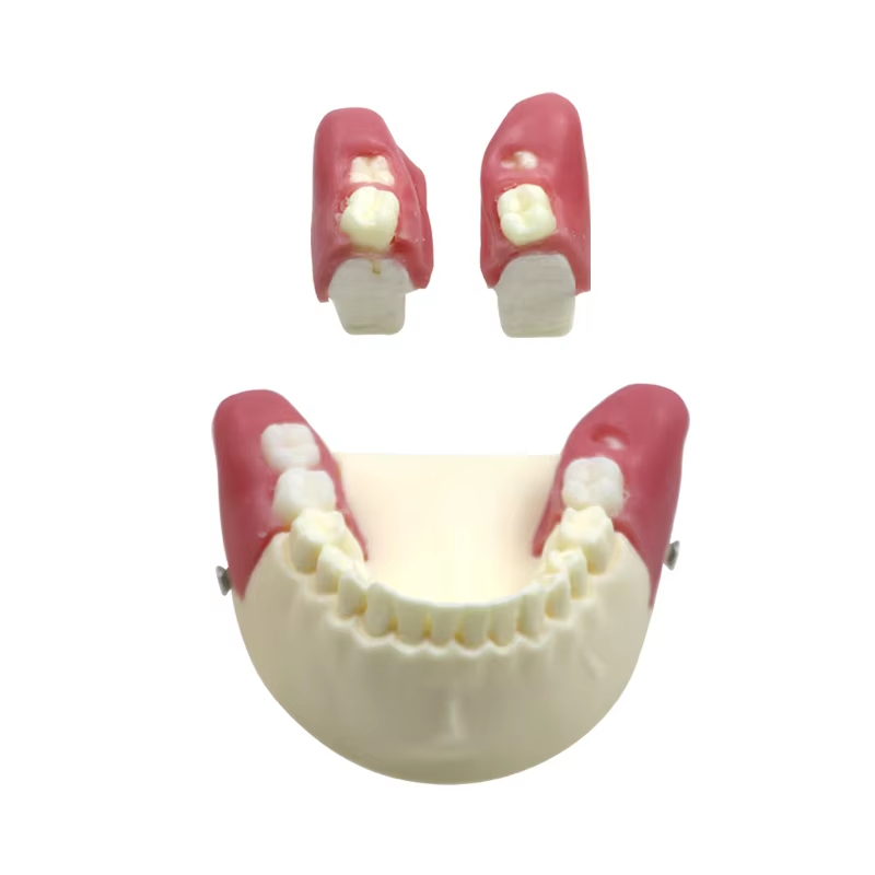 GREATLH Dental Wisdom Tooth Extraction Practice Model with Soft Gums ...