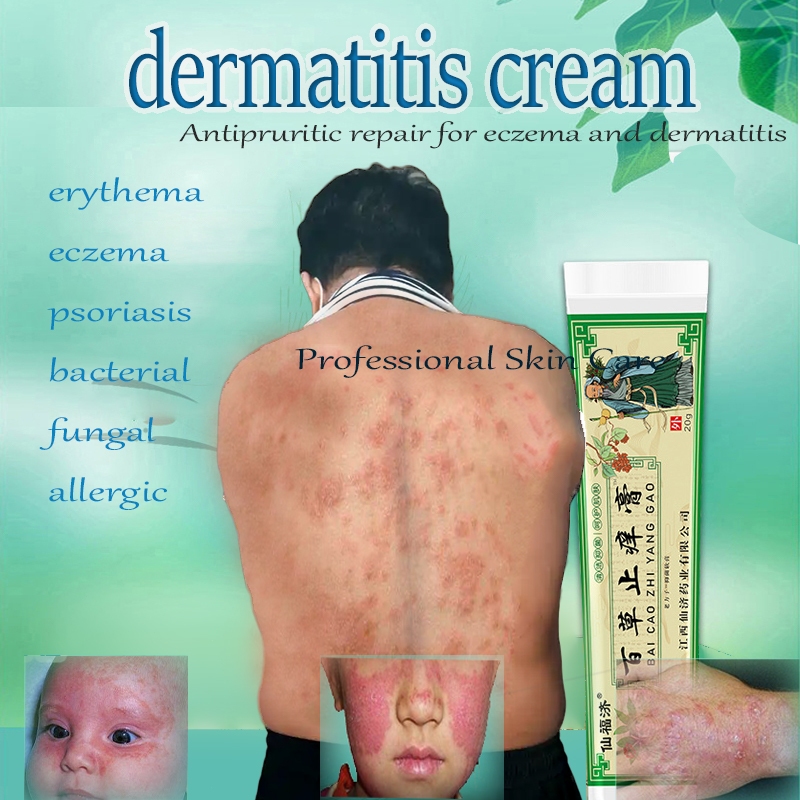 Dermatitis cream 20g Suit for Eczema Fungal Bacterial Erythema Beriberi ...