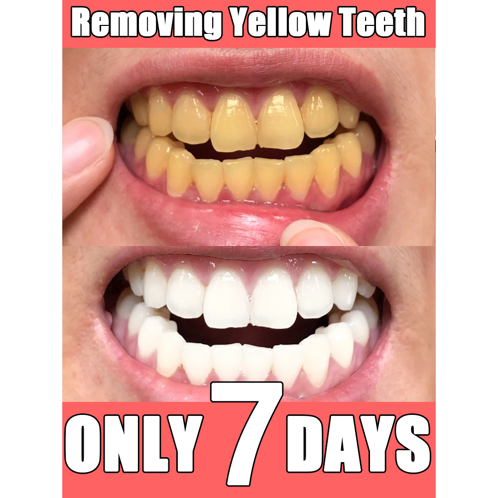 [7-day rapid whitening] Turn your teeth from yellow to white in 1 ...