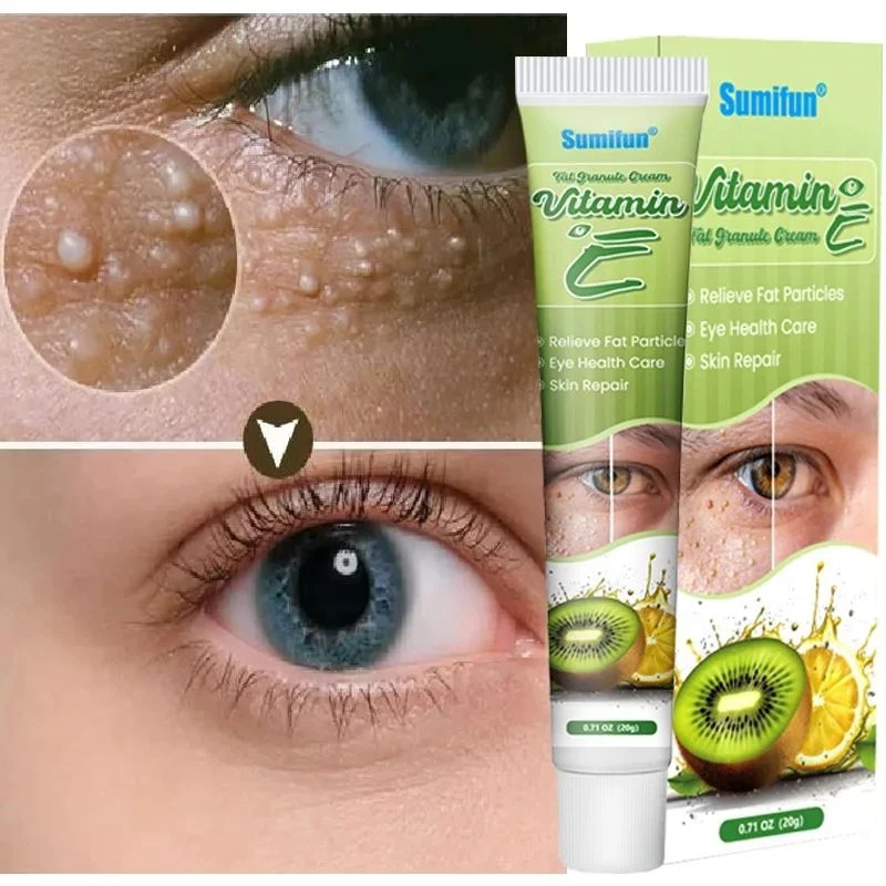 Vitamin E Krim Milia Seed Remover Eye Cream Fat Granule Syringoma Milia ...