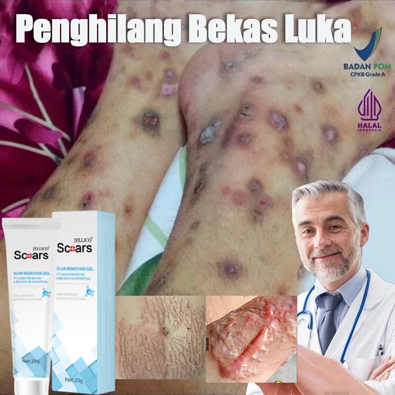 [Buy 2 get 1 free] ubat hilangkan parut bekas luka bakar, bekas gigitan ...