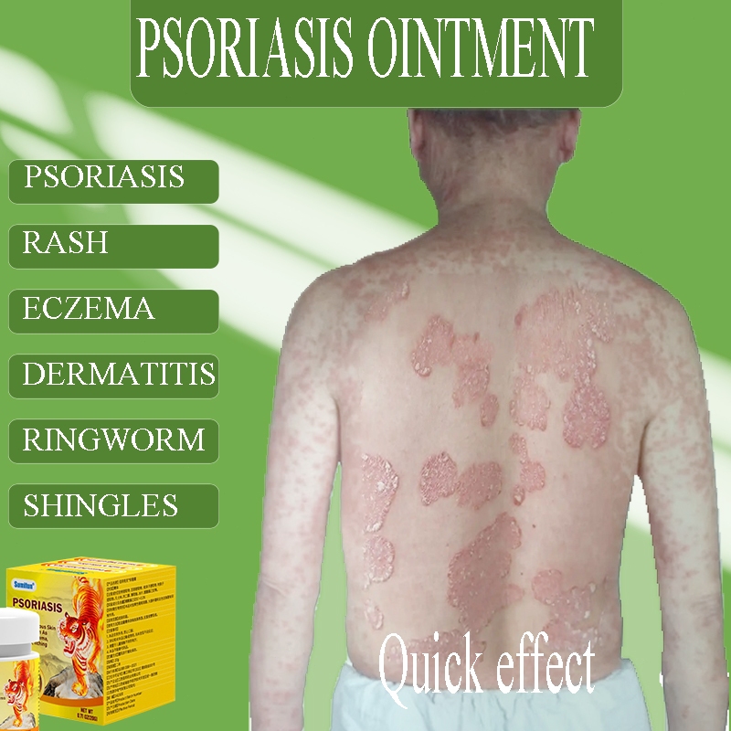 Psoriasis cream 20g for Erythema Ringworm Tinea Fungal bacterial Eczema ...