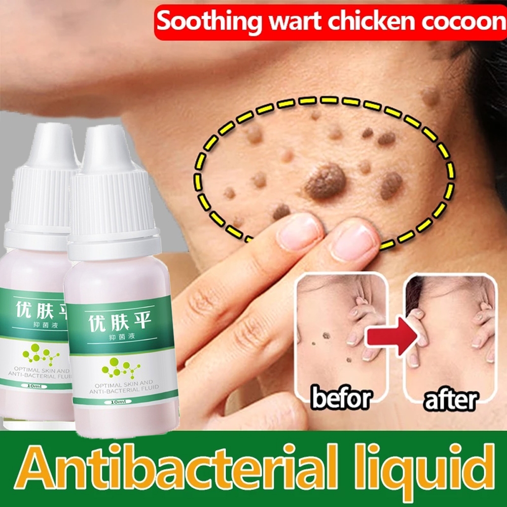 Foot Corn Warts Liquid Skin Tag Antibacterial Solution callus remover ...