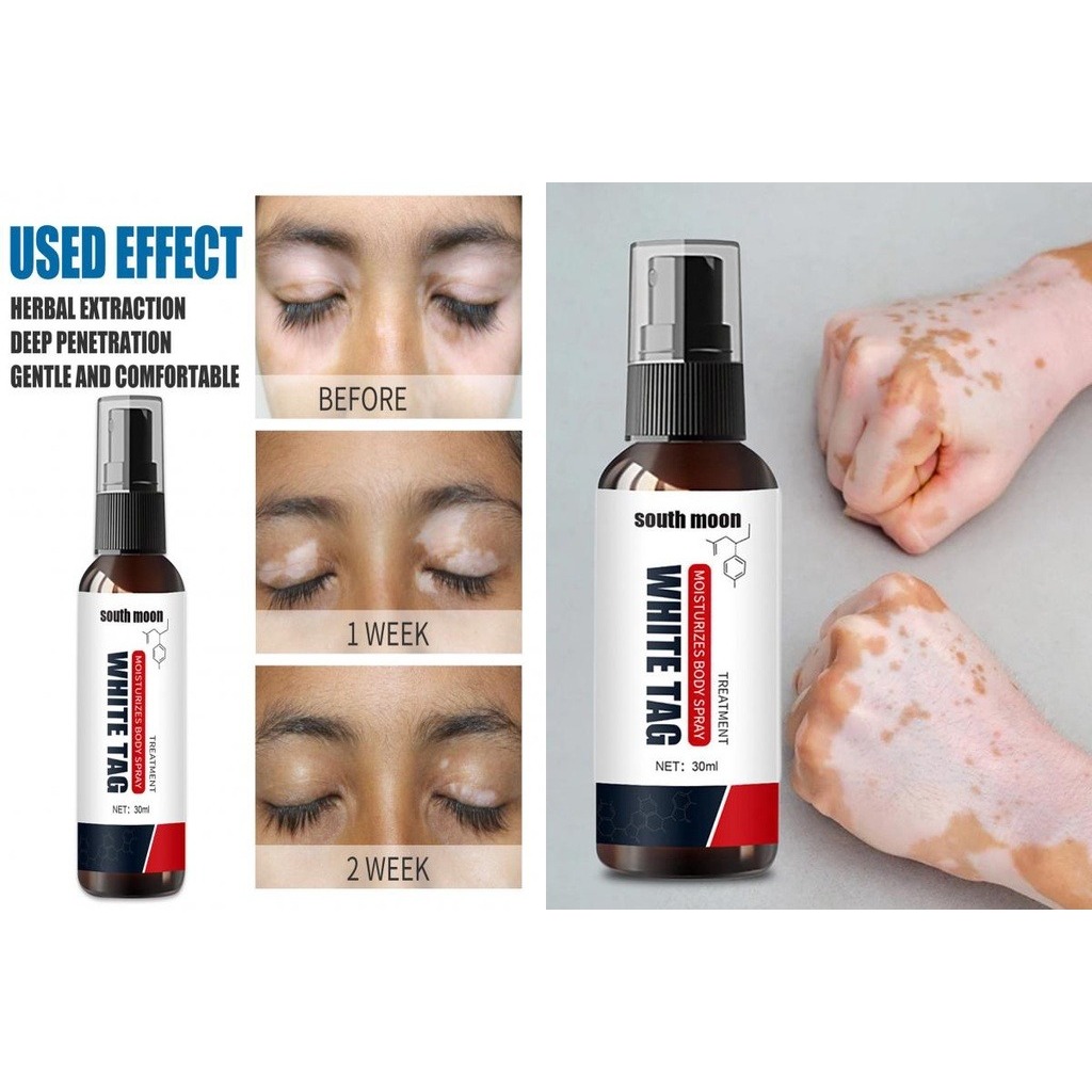 Plant Essence South Moon Vitiligo Treatment Spray 30ml White Tag ...