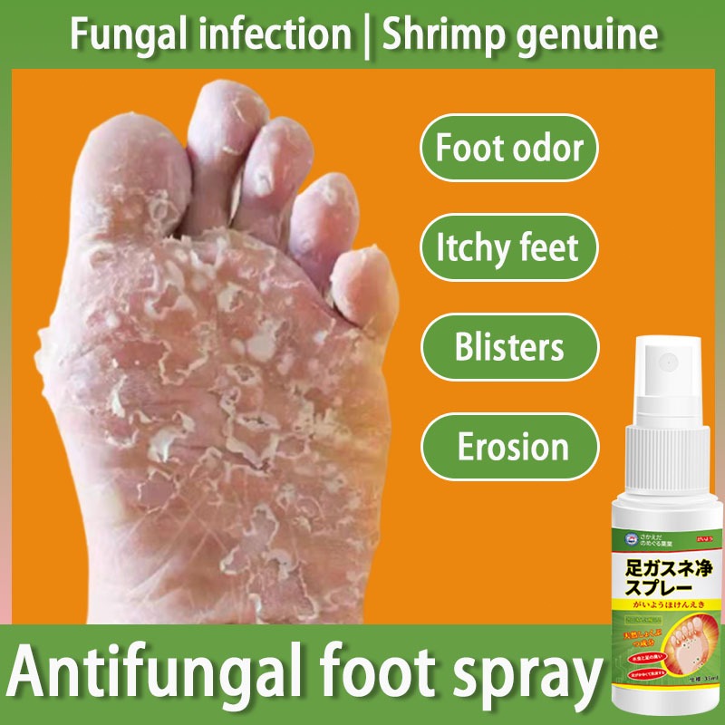 Antifungal foot spray Foot deodorant Fungal infection/athlete's foot ...