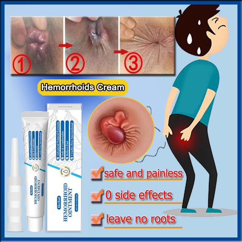 Ubat Buasir 100% Berkesan Herbal Hemorrhoid Cream Relieve Dubur Sakit Gatal Bengkak Berdarah ...