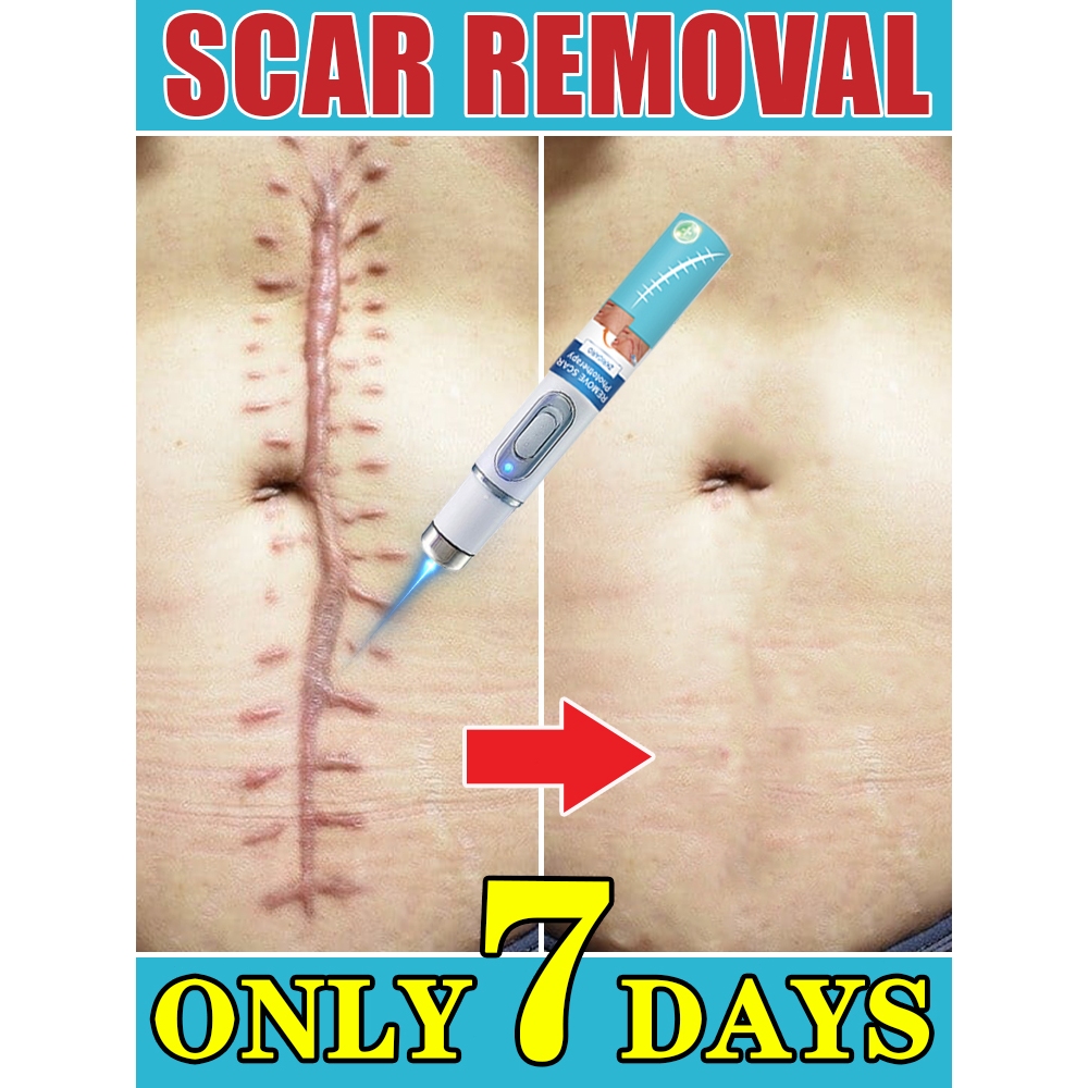 [Quick scar removal] Laser scar treatment pen, effectively removes old ...