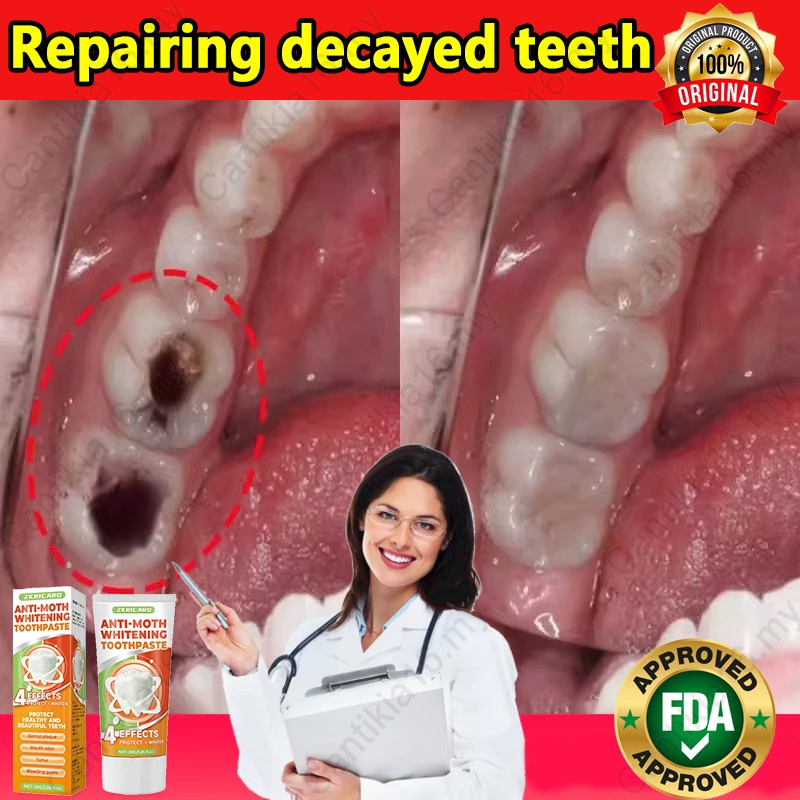 Anti-caries toothpaste, teeth repair toothpaste Tooth Decay Repair deep ...
