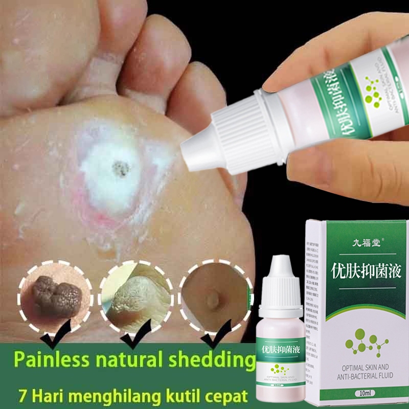 Foot Corn Warts Liquid Skin Tag Antibacterial Solution callus remover ...