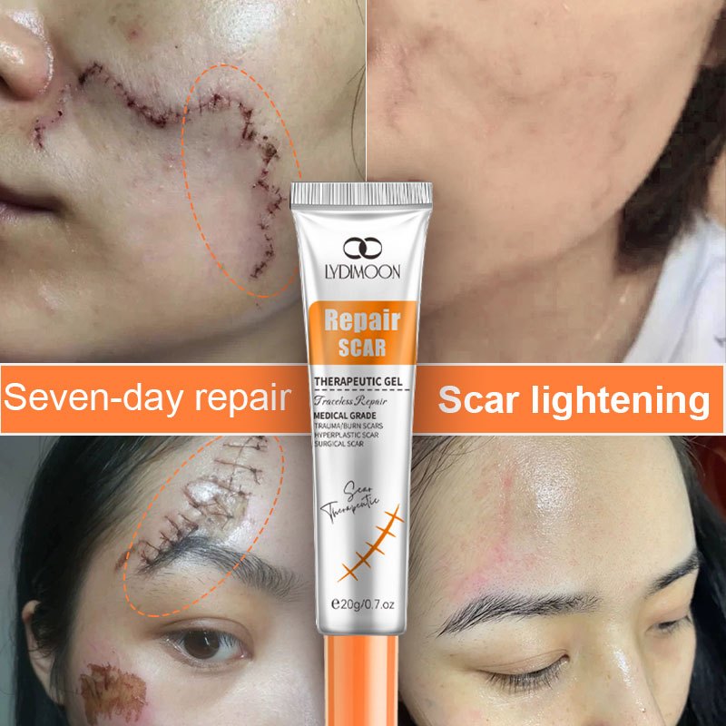 scar cream acne scar acne scar treatment scar removal 20g Proliferative ...