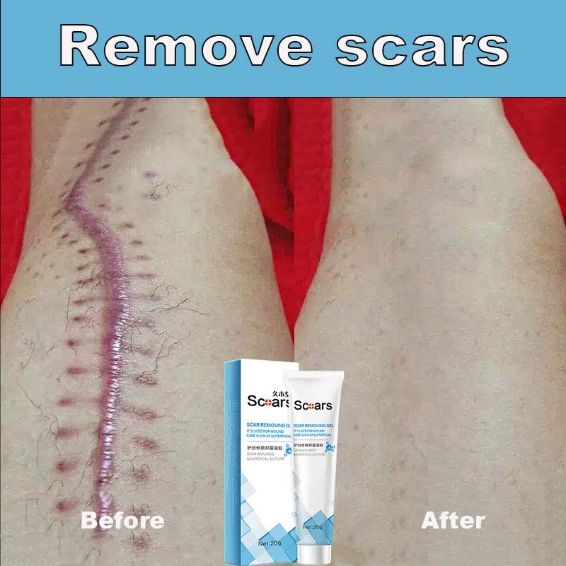 Scar removal cream Scar remover cream Scar removing gel Scar removal ...