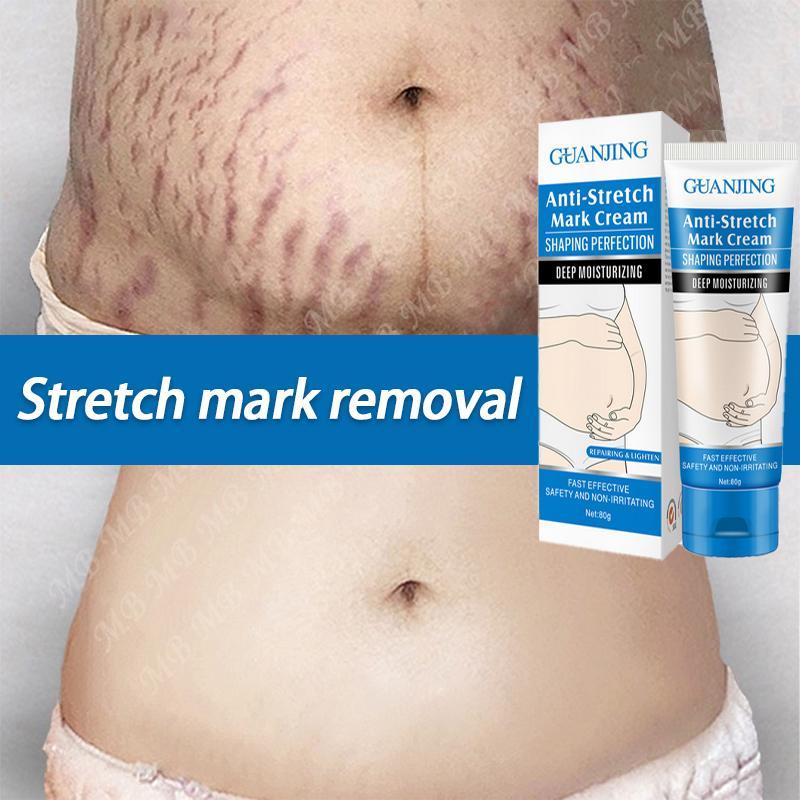 Stretch mark remover Anti-Stretch Mark Cream Stretch Marks Treatment ...