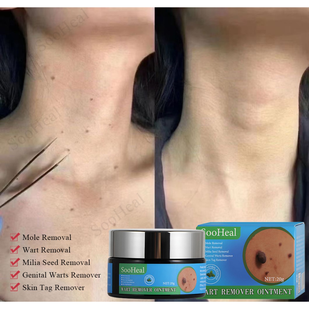 【SooHeal】wart remover warts removal cream skin tag remover mole remover ...