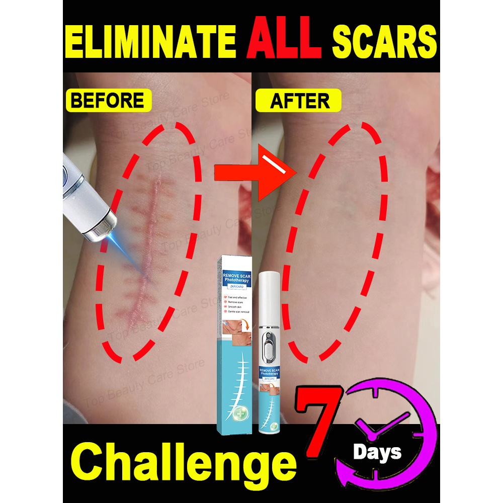 🌟【Medical-grade pulsed light】Scar laser pen, remove hyperplastic scars ...