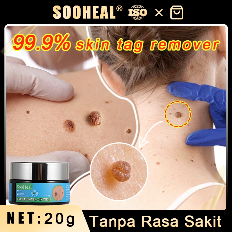 【SooHeal】Skin Tag Remover buang tahi lalat ubat ketuat Skin gentle and ...