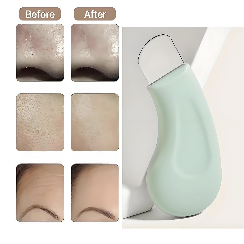 Blackhead Removal Shovel Silicone Handle Dead Skin Acne Silicone Shovel ...
