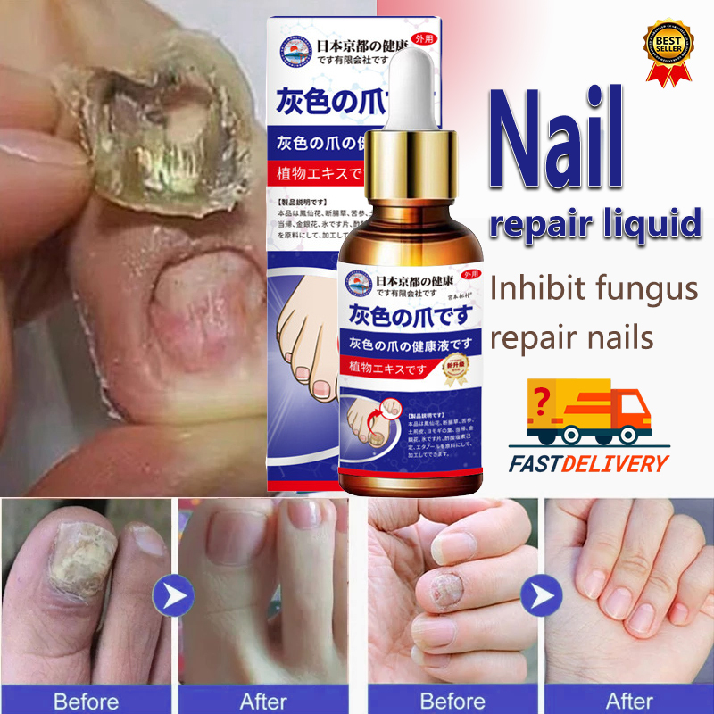 nail fungus treatment ubat kuku cekam Nail Repair Essence Serum Extra ...