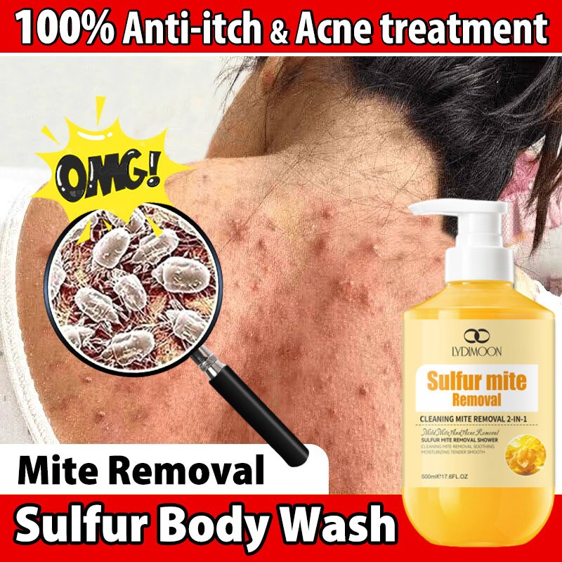 Sulfur Soap Acne Body Wash Relieve Itching Remove Acne Remove Body ...