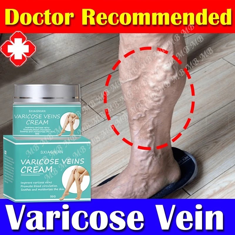 Varicose Vein Crem varicose veins cream original varicose veins ...