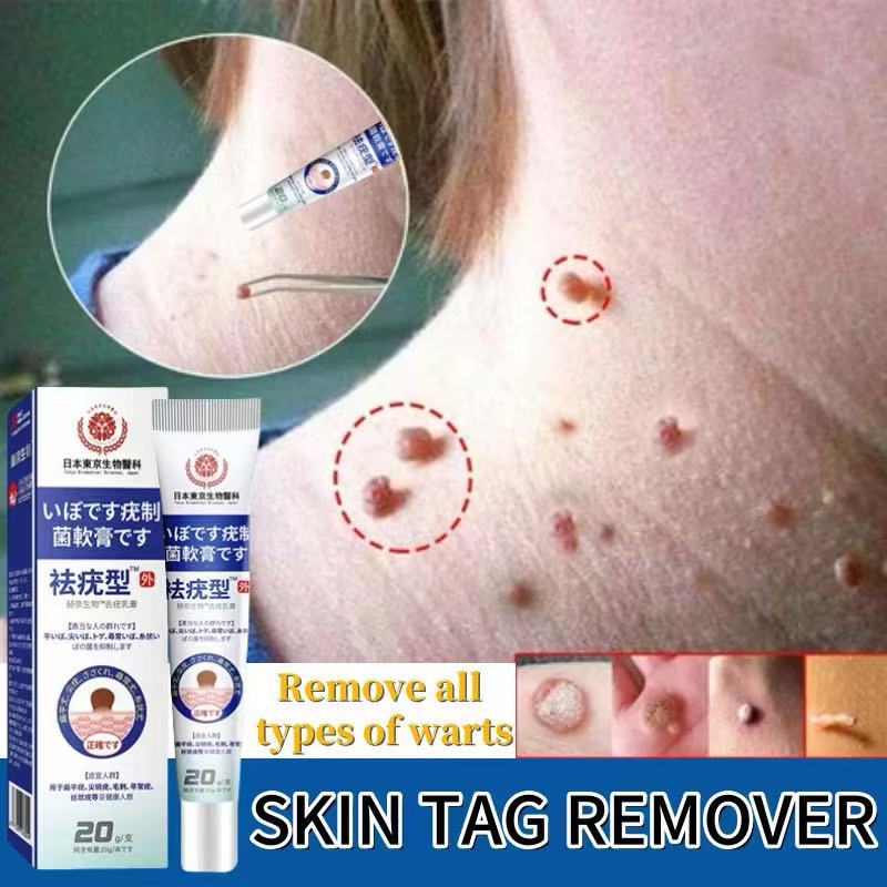 Wart Removal Skin Mark Remover 20g Wart Removal Cream 7 Days Effective ...