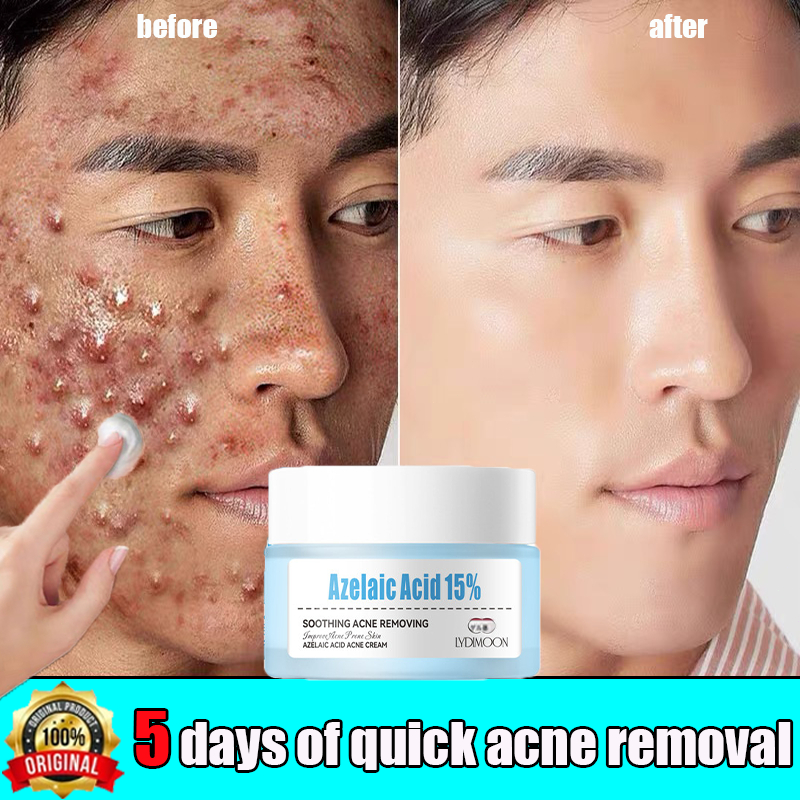 Acne cream pimple cream acne gel acne spot cream 30g Quickly remove ...
