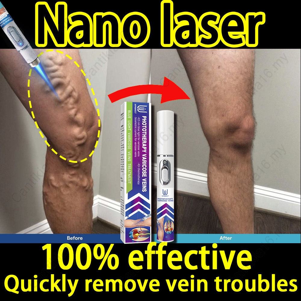 Varicose vein laser pen, fast effect, the latest technology to remove ...