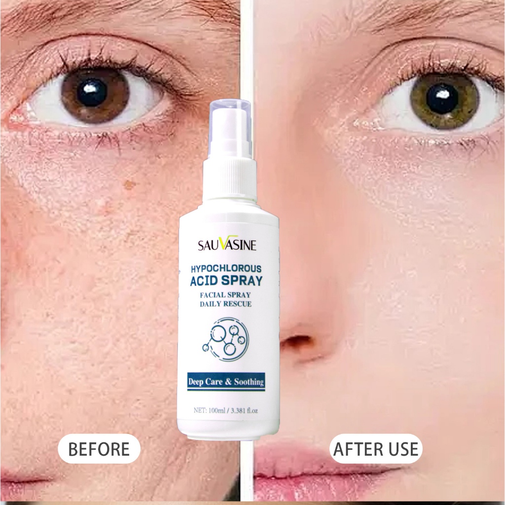 New Hypochlorous Acid Facial Spray Reduce Redness Swelling Acne ...