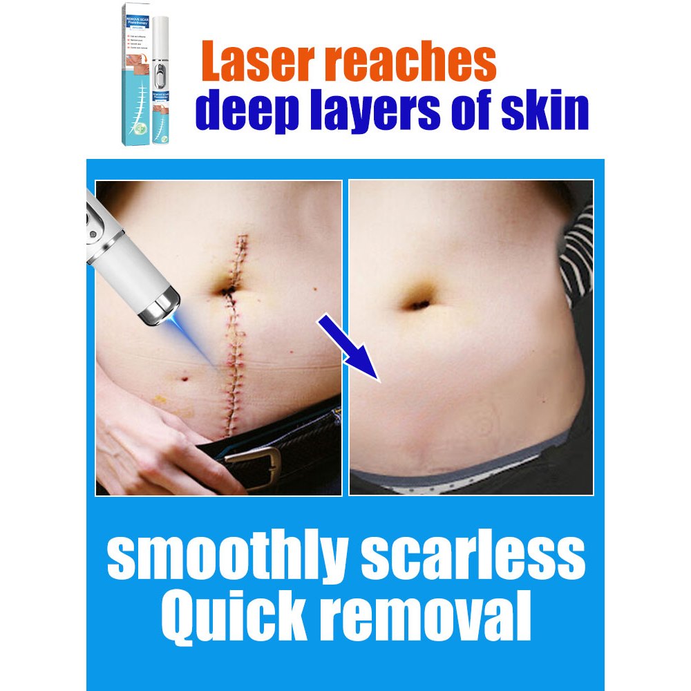 [New Product] Laser scar treatment pen, effectively removes old scars ...