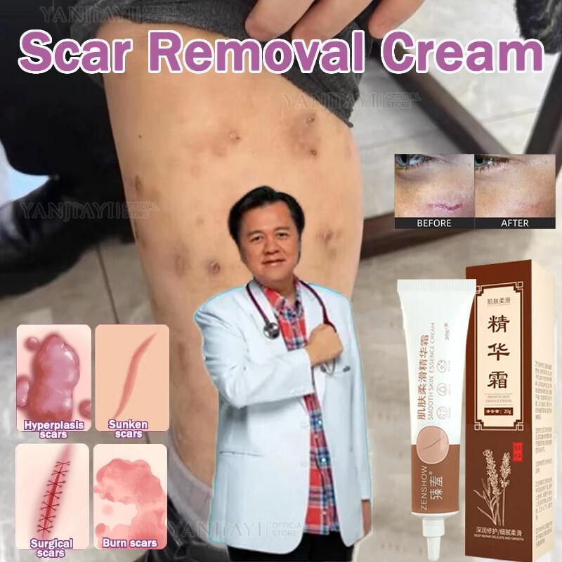 Visible effect 】 Scar Removing Cream can lighten scars,Repair scars ...