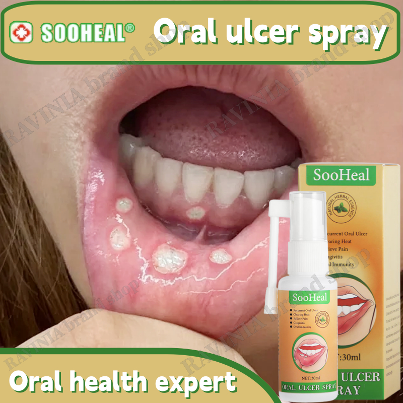 Mouth Ulcer spray Oral Ulcer Spray 30ml Ubat Sembur Ulser Mulut 口腔溃疡 ...