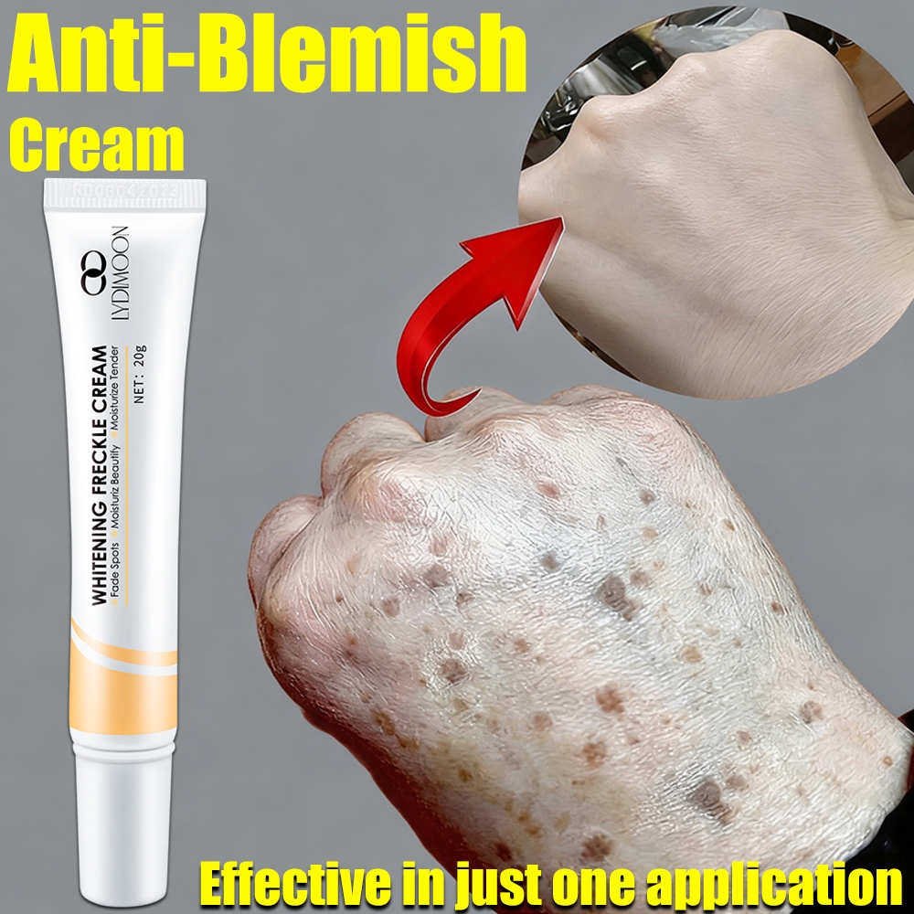 whitening freckle cream Remove Dark Spots dark Freckle melasma Anti ...