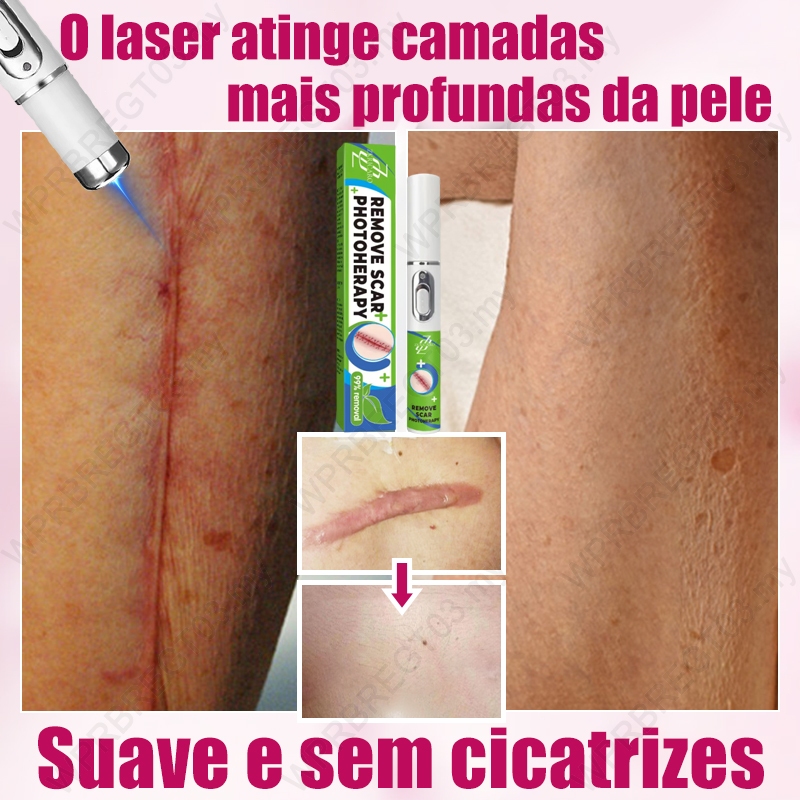 【Imported from Japan】Laser Scar Removal Pen, suitable for all types of ...
