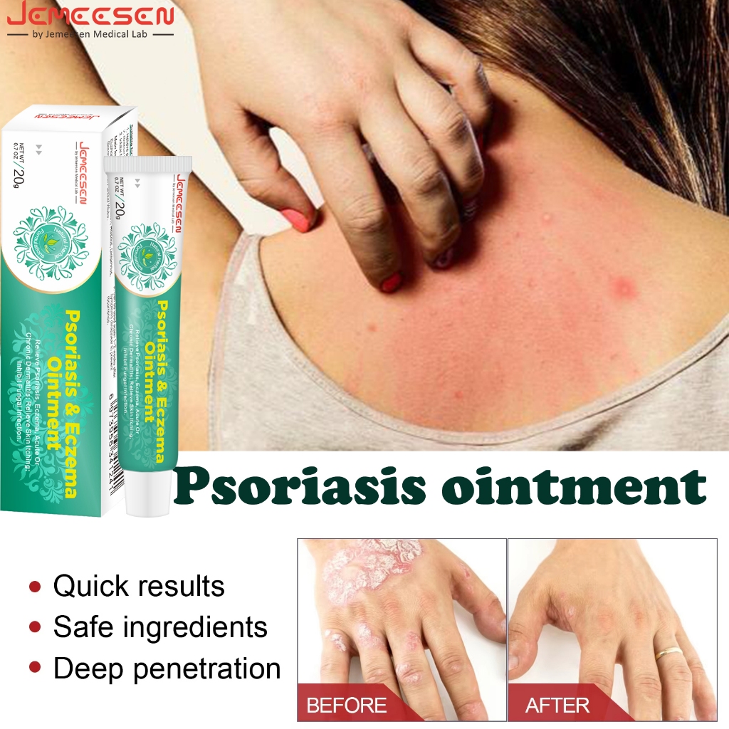 Jemeesen All-Natural Eczema Ointment 20g Antibacterial Treats Psoriasis ...