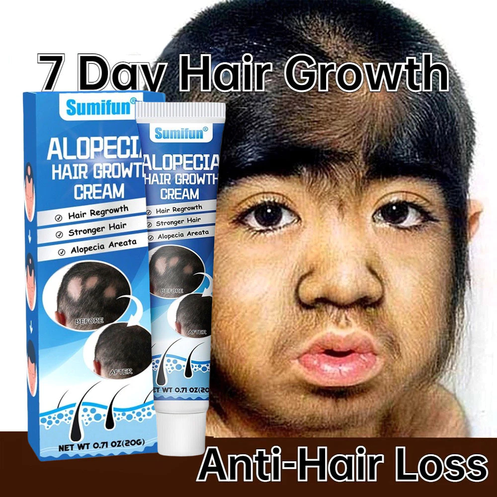 Baldness Cream Alopecia Hair Growth Cream 20g Dense Hair Beauty Hair ...