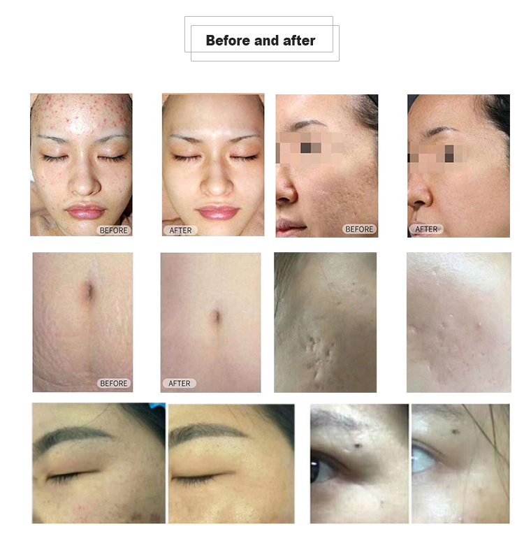 【Malaysia Warranty】CO2 laser dot matrix laser scar repair removing ...