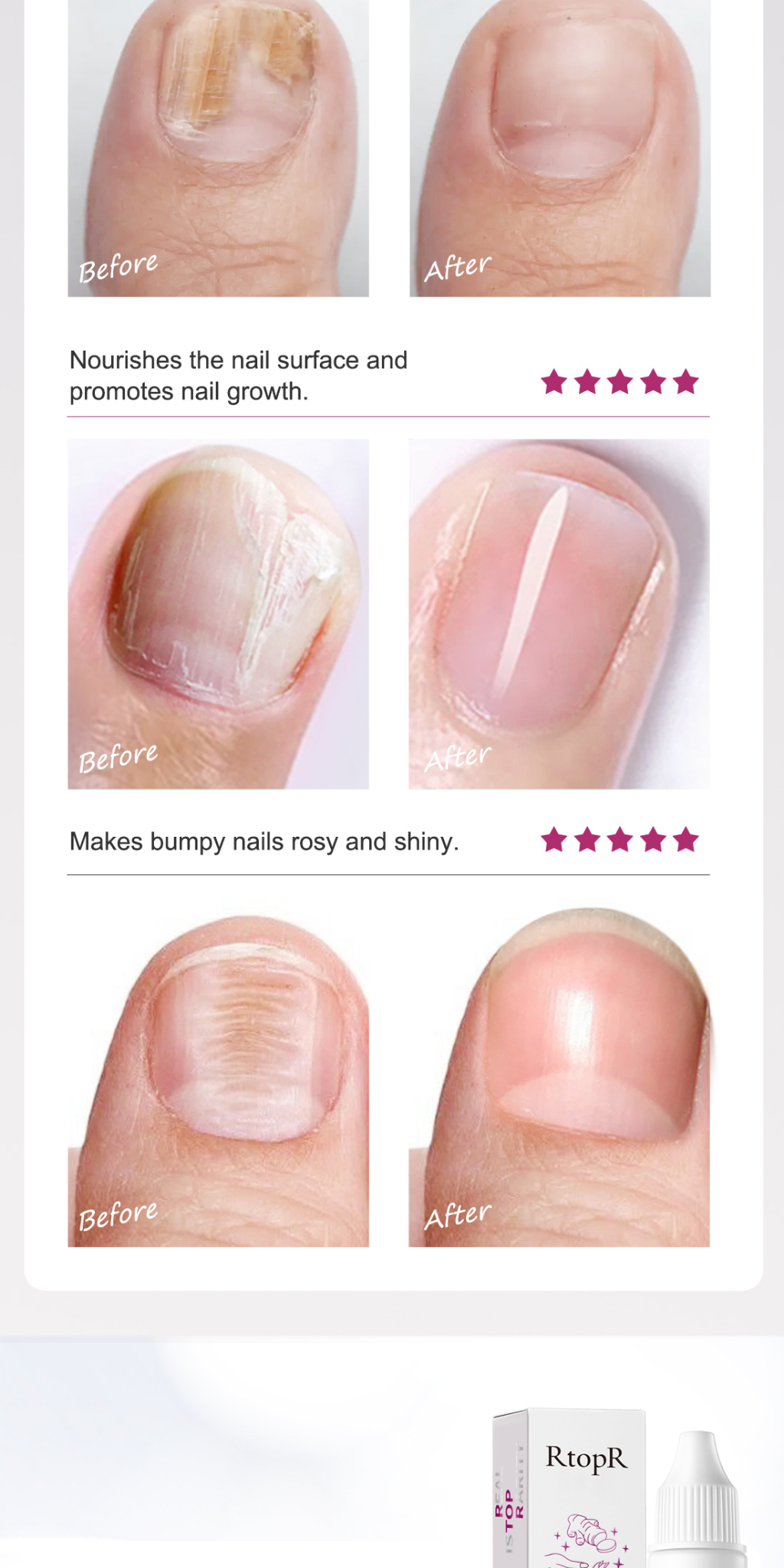 RtopR Ginger Antibacterial Nail Treatment Anti Onychomycosis Paronychia ...