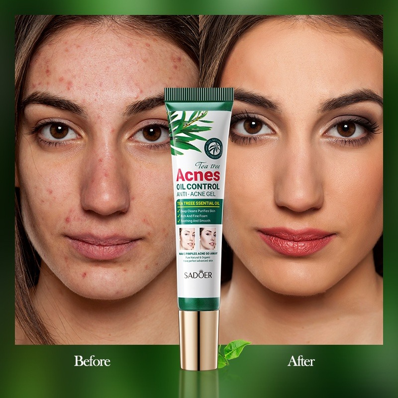 Original SADOER Tea Tree Acne Cream Gel 20g Lightens acne scars oil control shrink pores ...