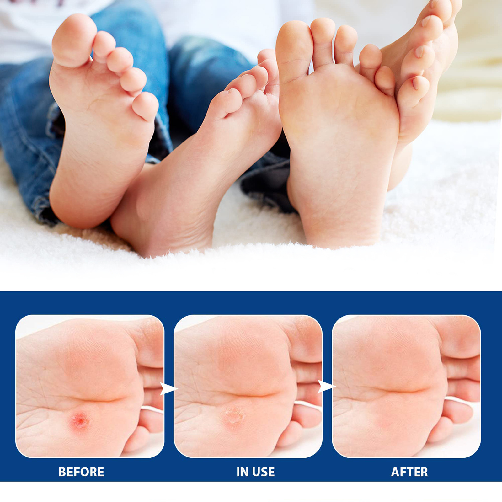 South Moon Wart and Corn Patch Removes Hard Calluses Calluses Warts ...