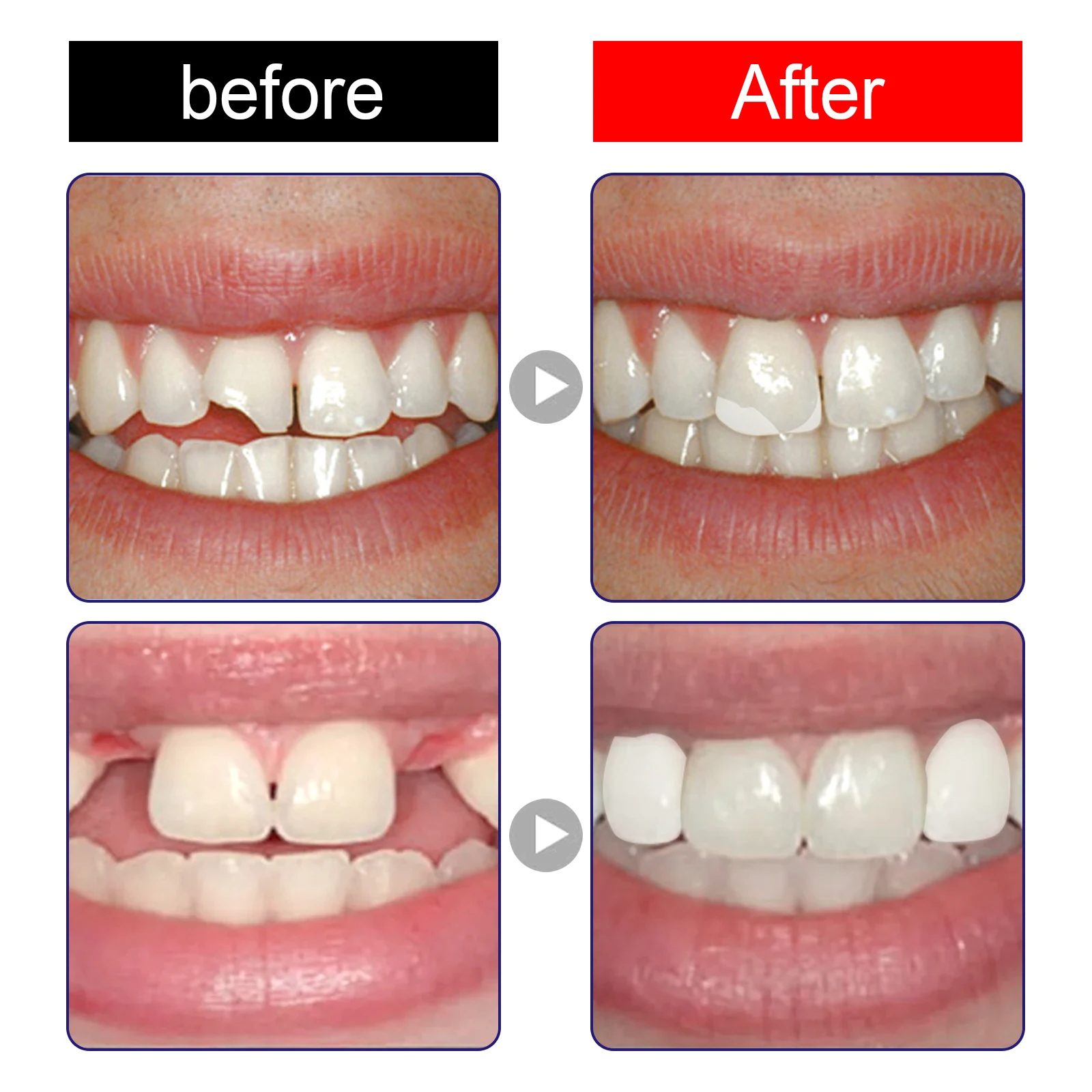 Temporary Tooth Repair Dental Resin Shapeable Teeth Glue Makeup ...