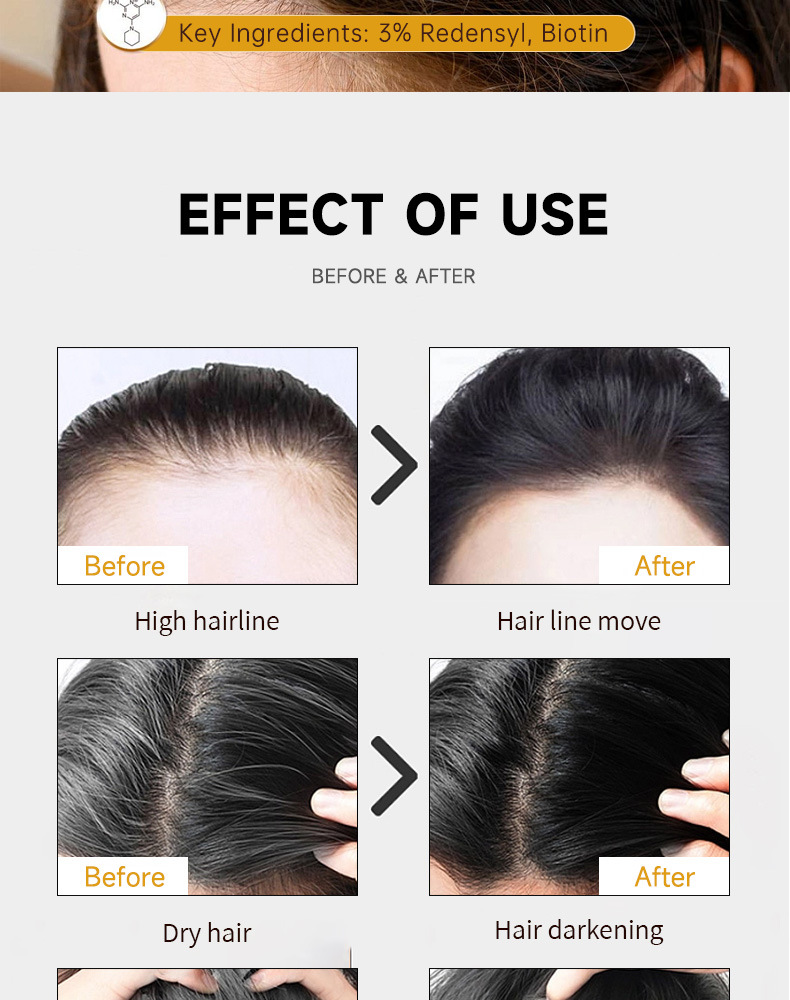 Dr.Medsam Hair Regrowth Treatment Serum, REDENSYL 3% with Biotin , Anti ...