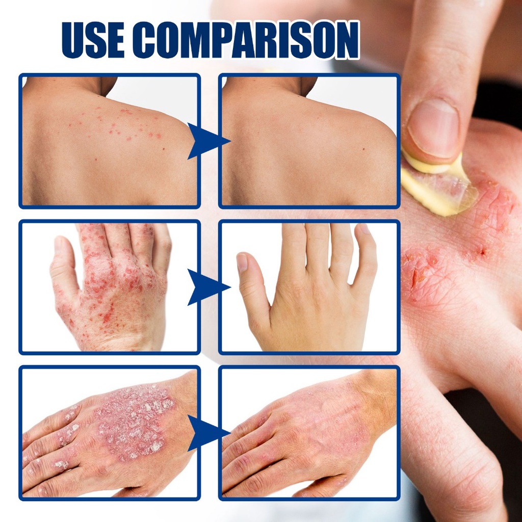 20g Skin Therapy Healing Cream Itch Relief Dermatitis Eczema Fungal ...