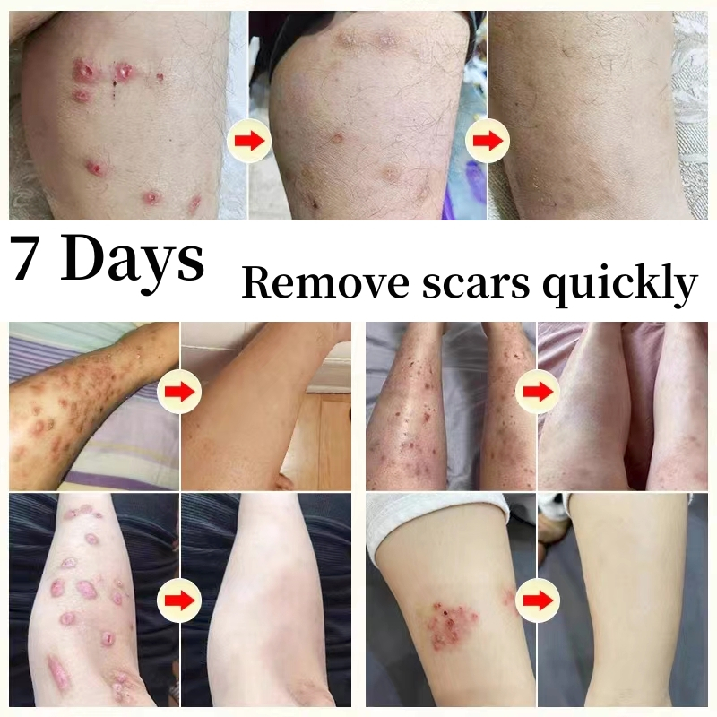 krim hilangkan parut hitam Menghilangkan bekas luka lama Ubat parut ...
