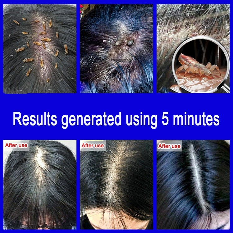 Shampoo kutu rambut ubat kutu rambut manusia Children and adults lice ...