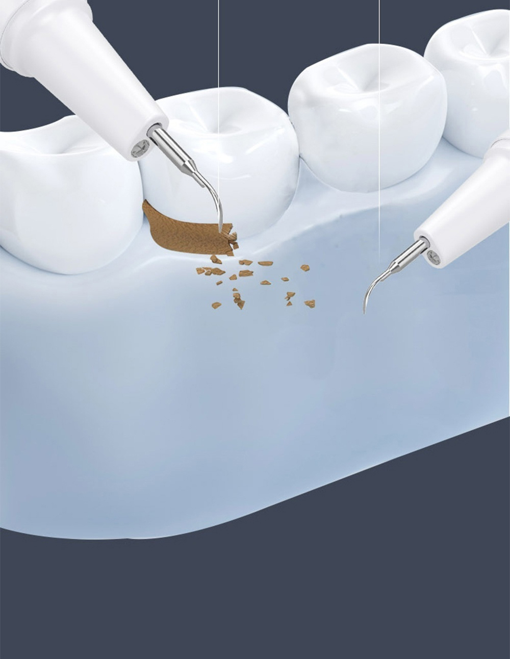 INSMART Dental Scaler Electric Dental Scaler Removes Tartar Without ...