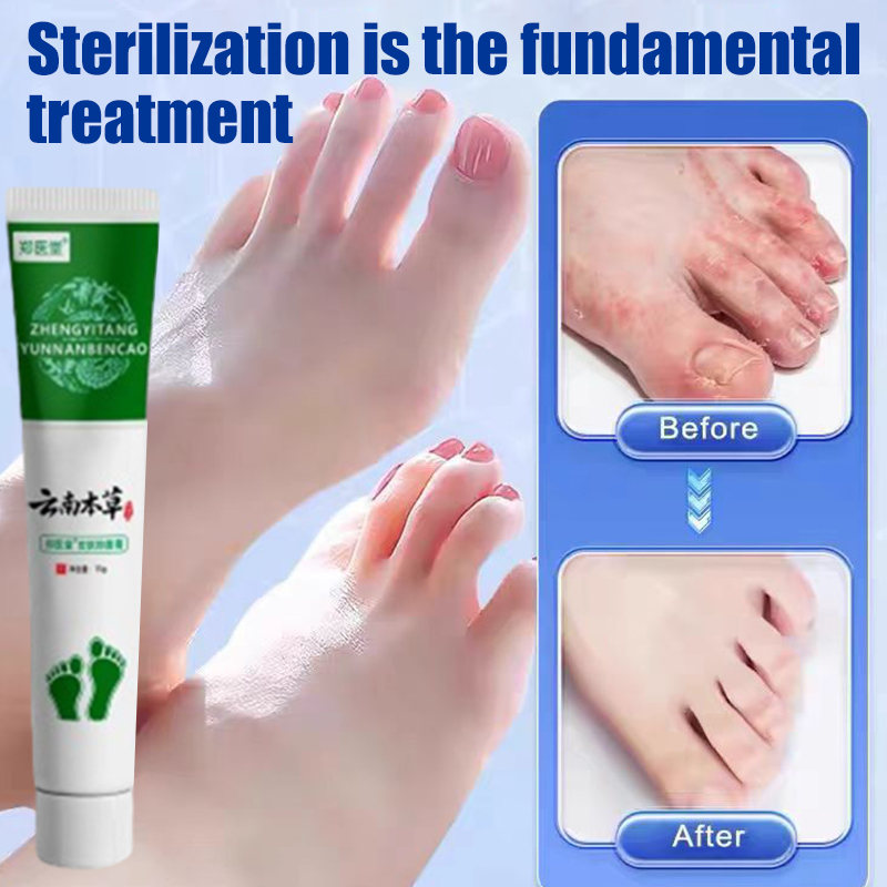 【In stock】Ubat kulat air kaki ubat kaki berbau Kaki mengelupas Foot ...