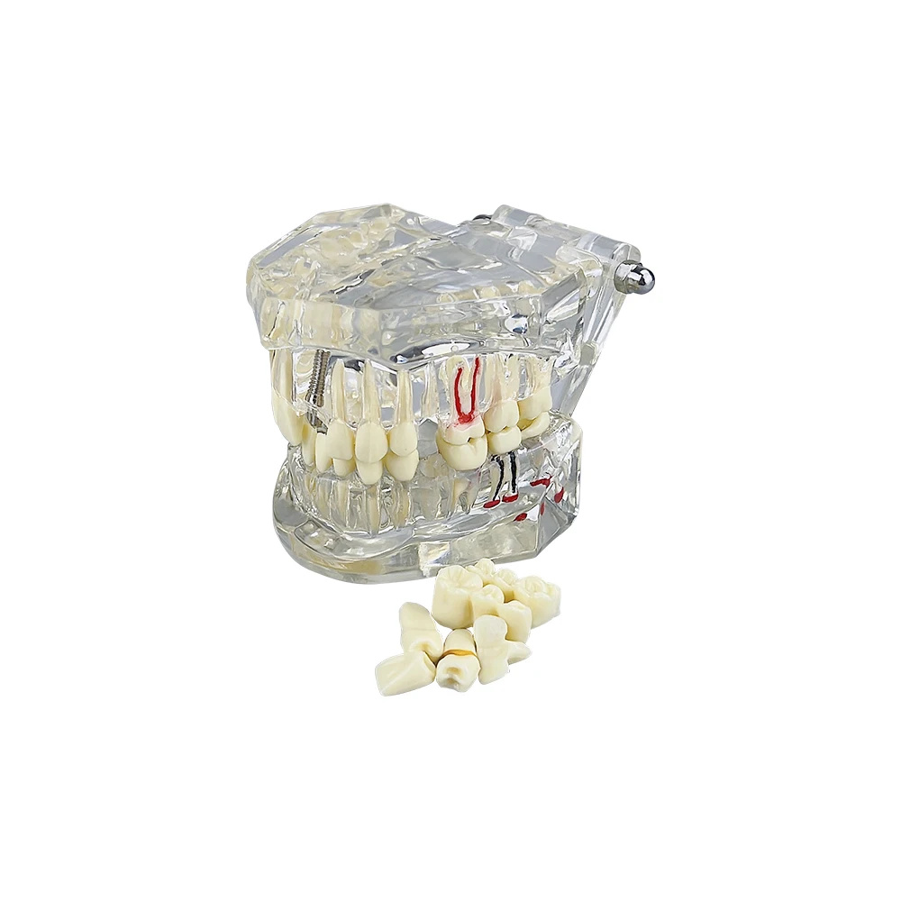 Dental Model Teeth Implant Restoration Bridge Teaching Study Typodont ...