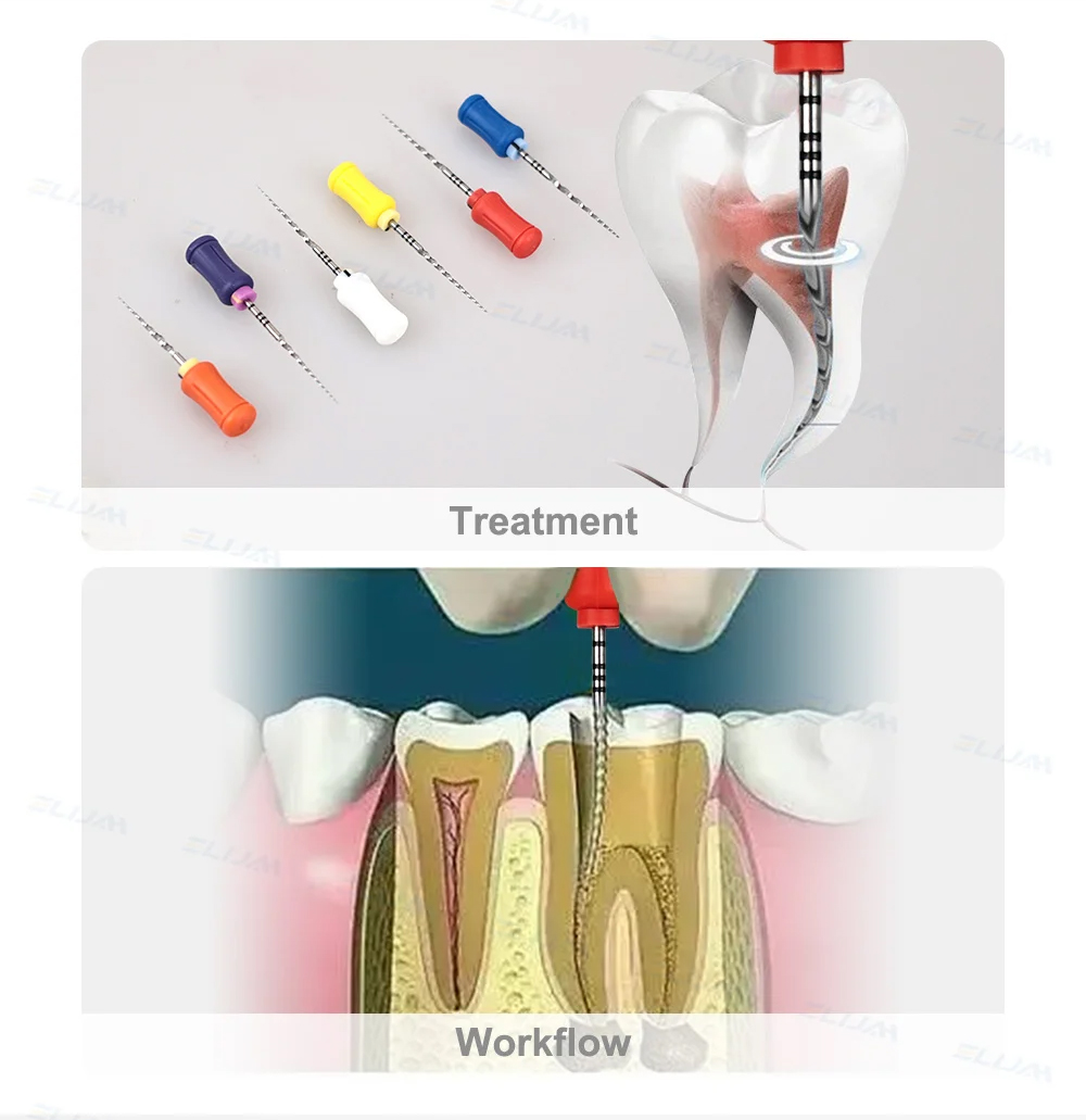 6pcs Dental Maillefer Hand Use Protaper Universal Root Canal Niti File ...