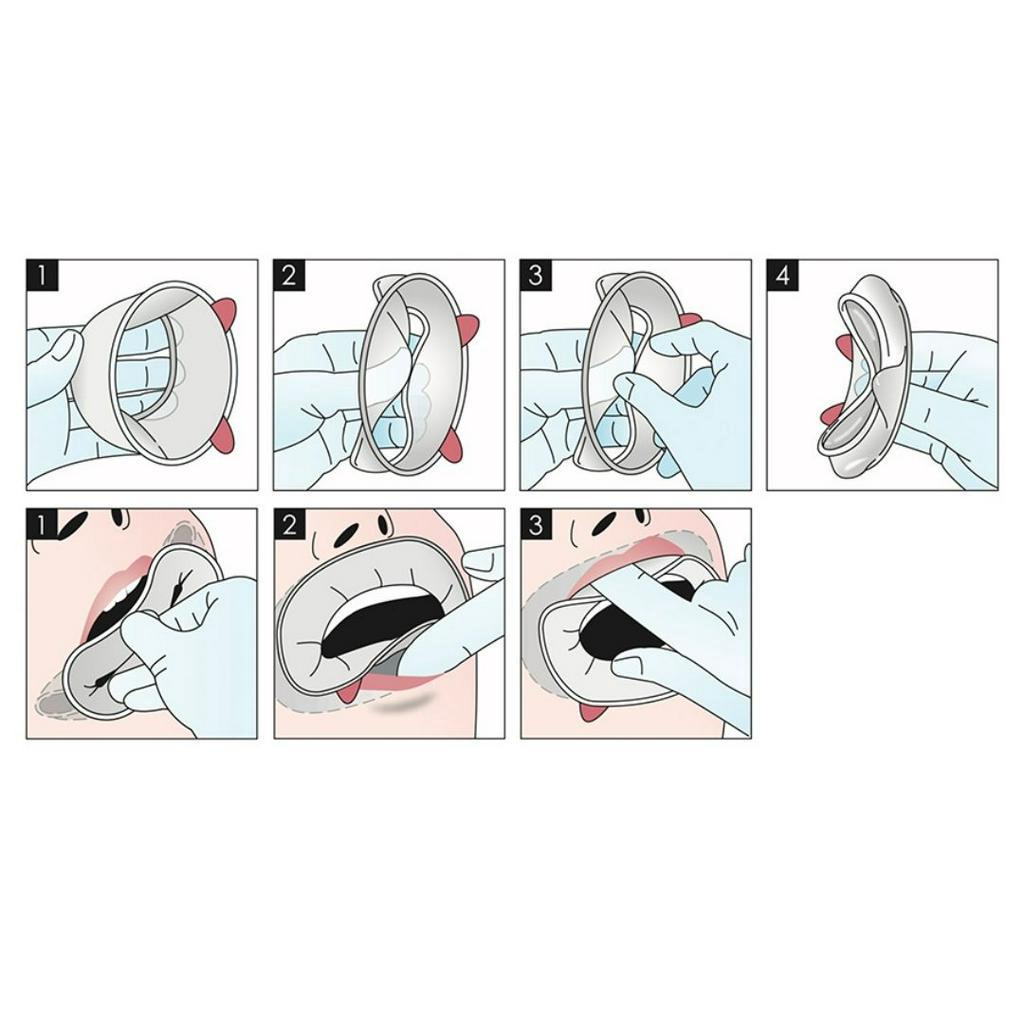 5pcs ivoclar vivadent 3D three-dimensional Junior Mouth opener dental ...
