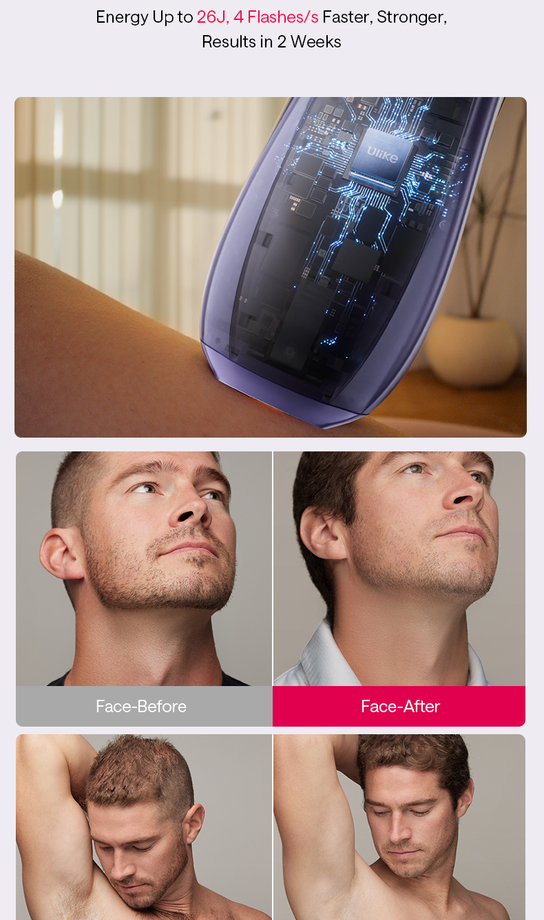 Ulike Air 10 Pro Ice Cooling IPL Hair Removal Device Beauty | Shopee Malaysia