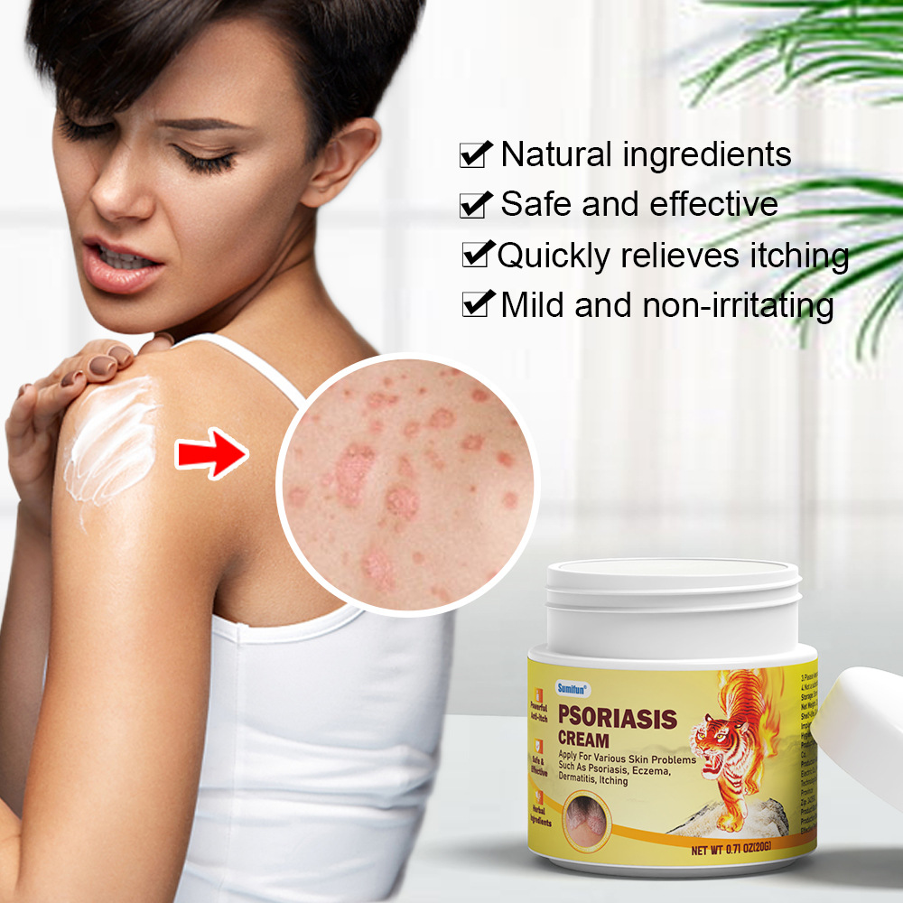 Psoriasis cream 20g for Erythema Ringworm Bacterial Tinea Eczema ...